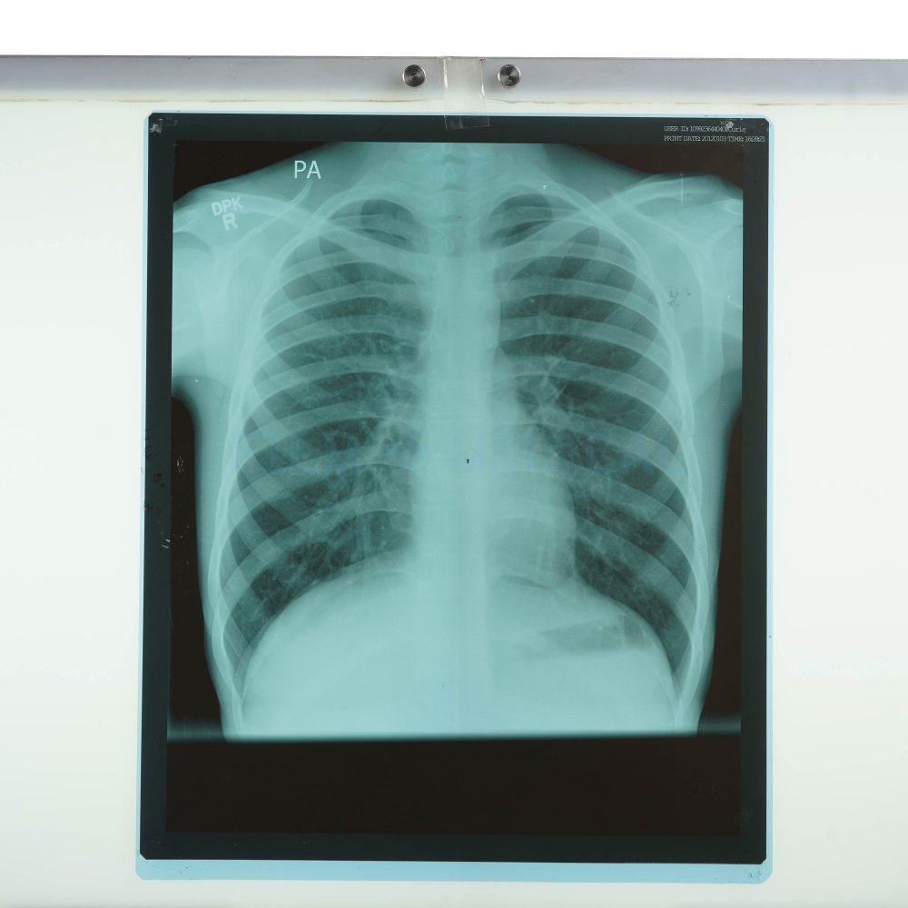 X-Ray Chest | FILM MEDICAL