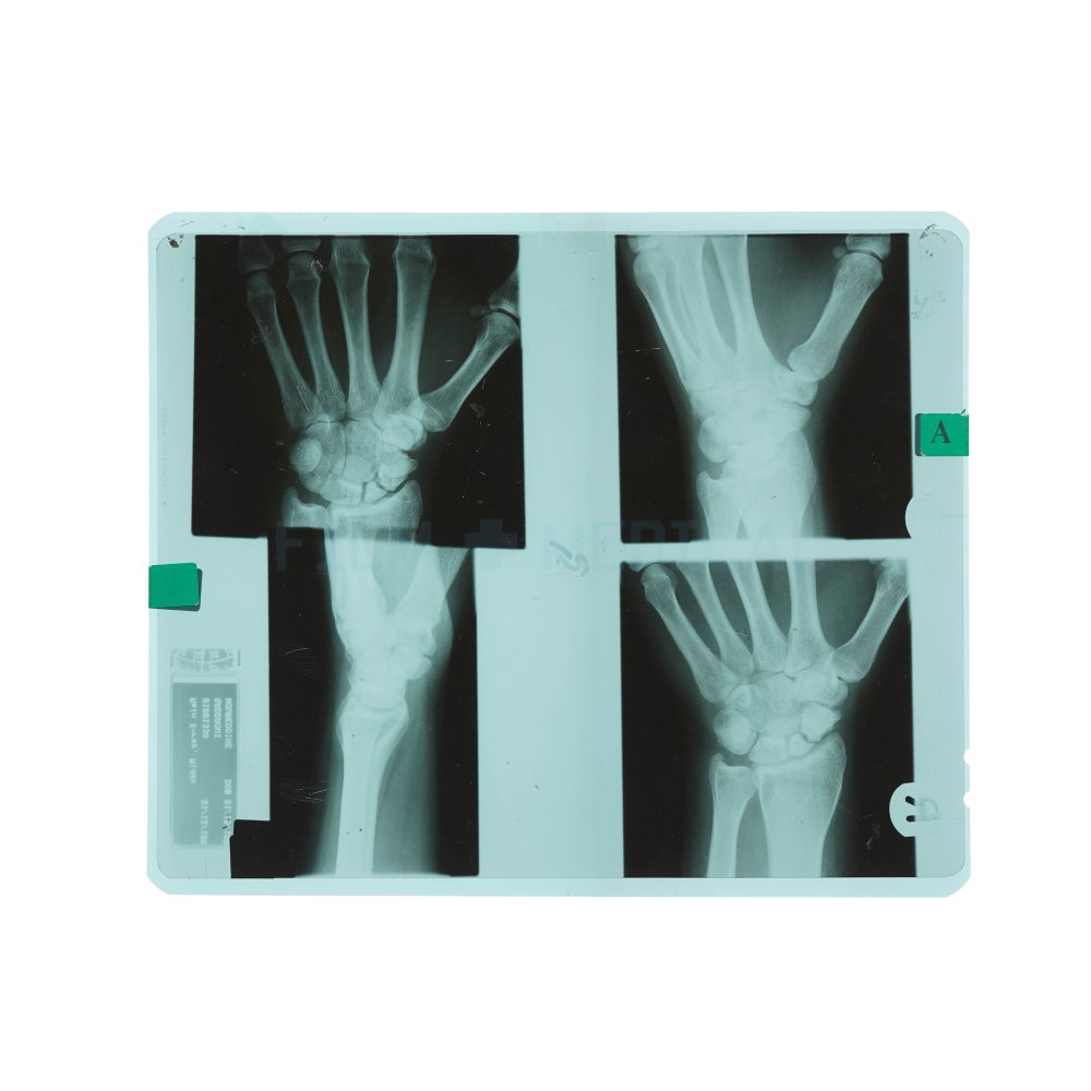 X-Ray Hand | FILM MEDICAL