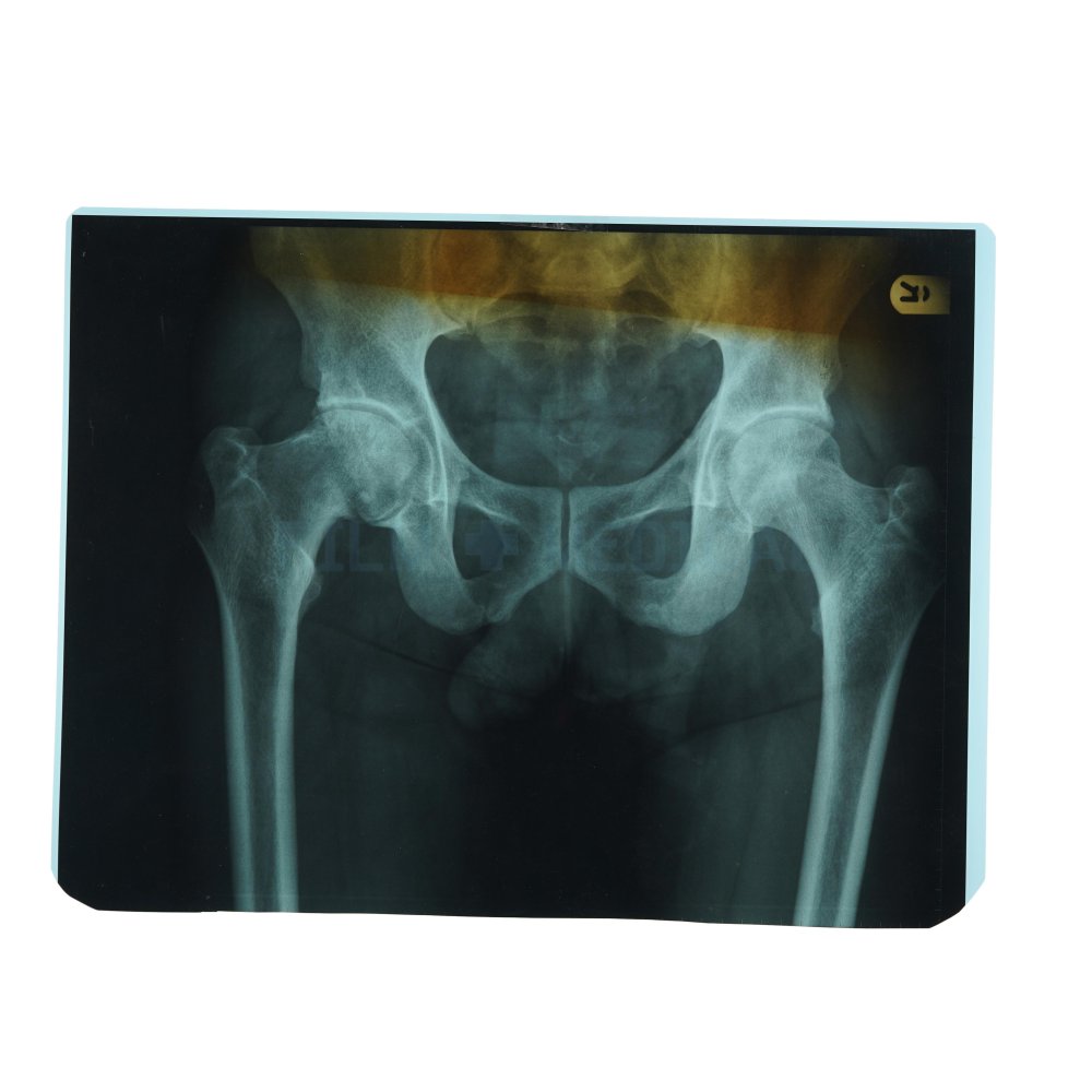 X Ray Pelvis Film Medical 3912